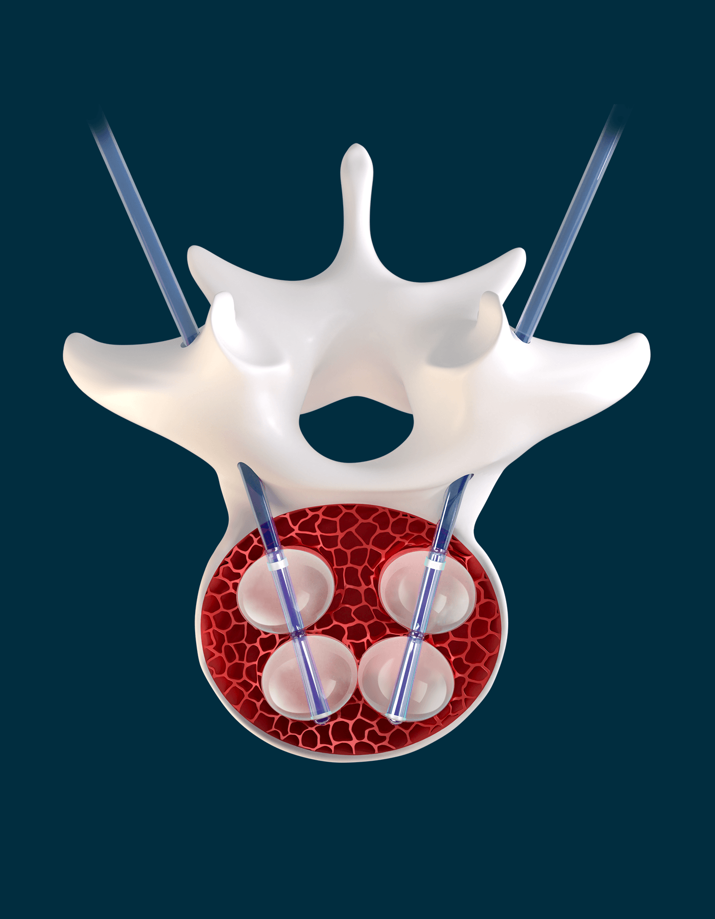 Vacuum Syringe | Joline
